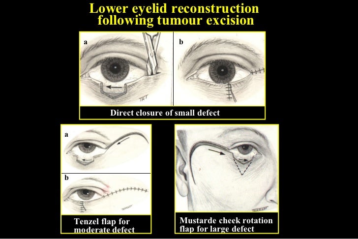 05 Malignant Eyelid Tumours