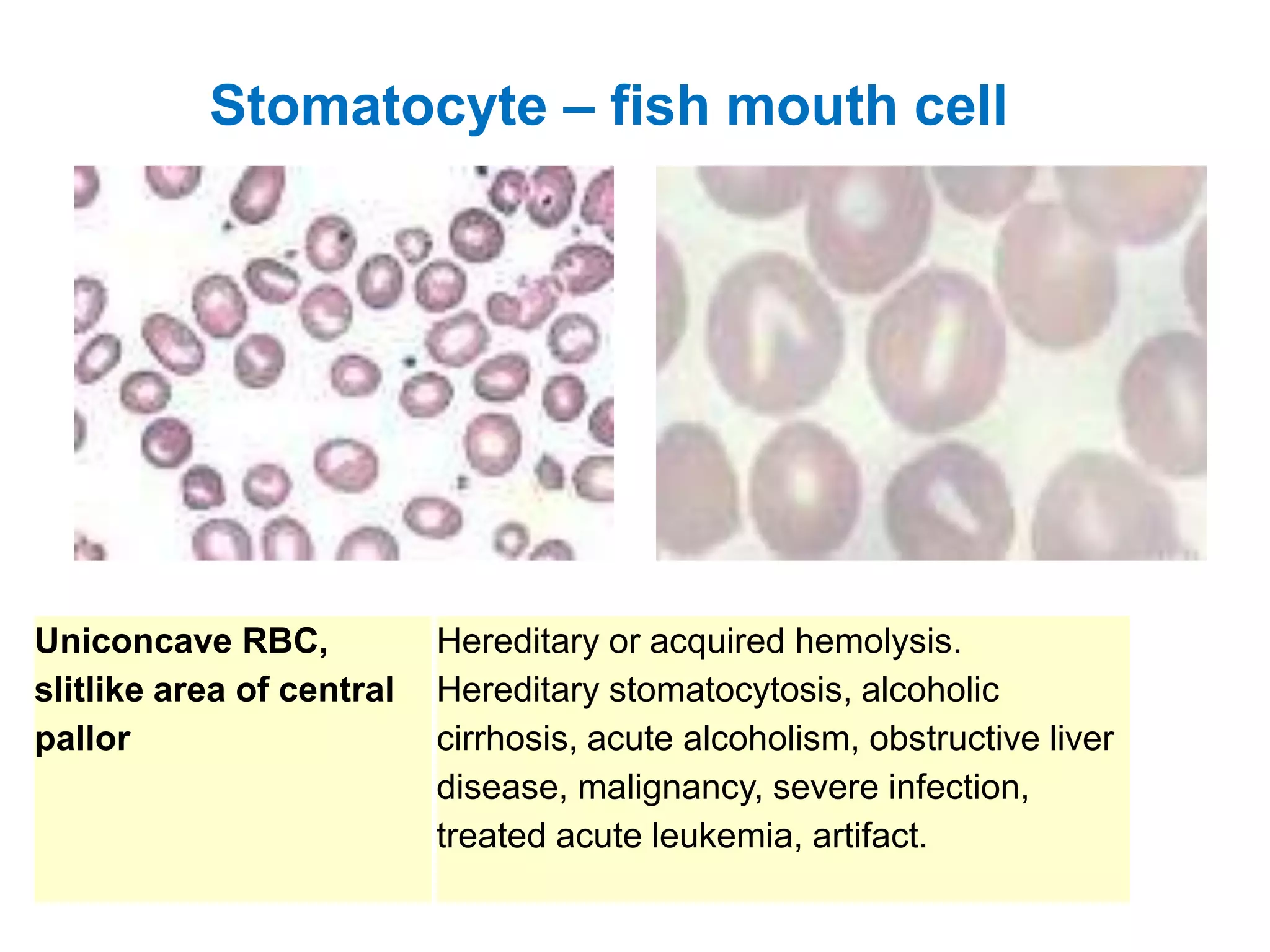 05 peripheral blood smear examination | PPTX
