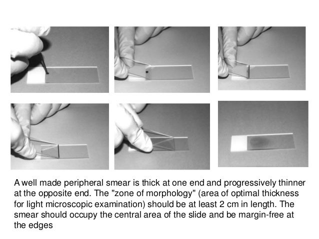 05 peripheral blood smear examination