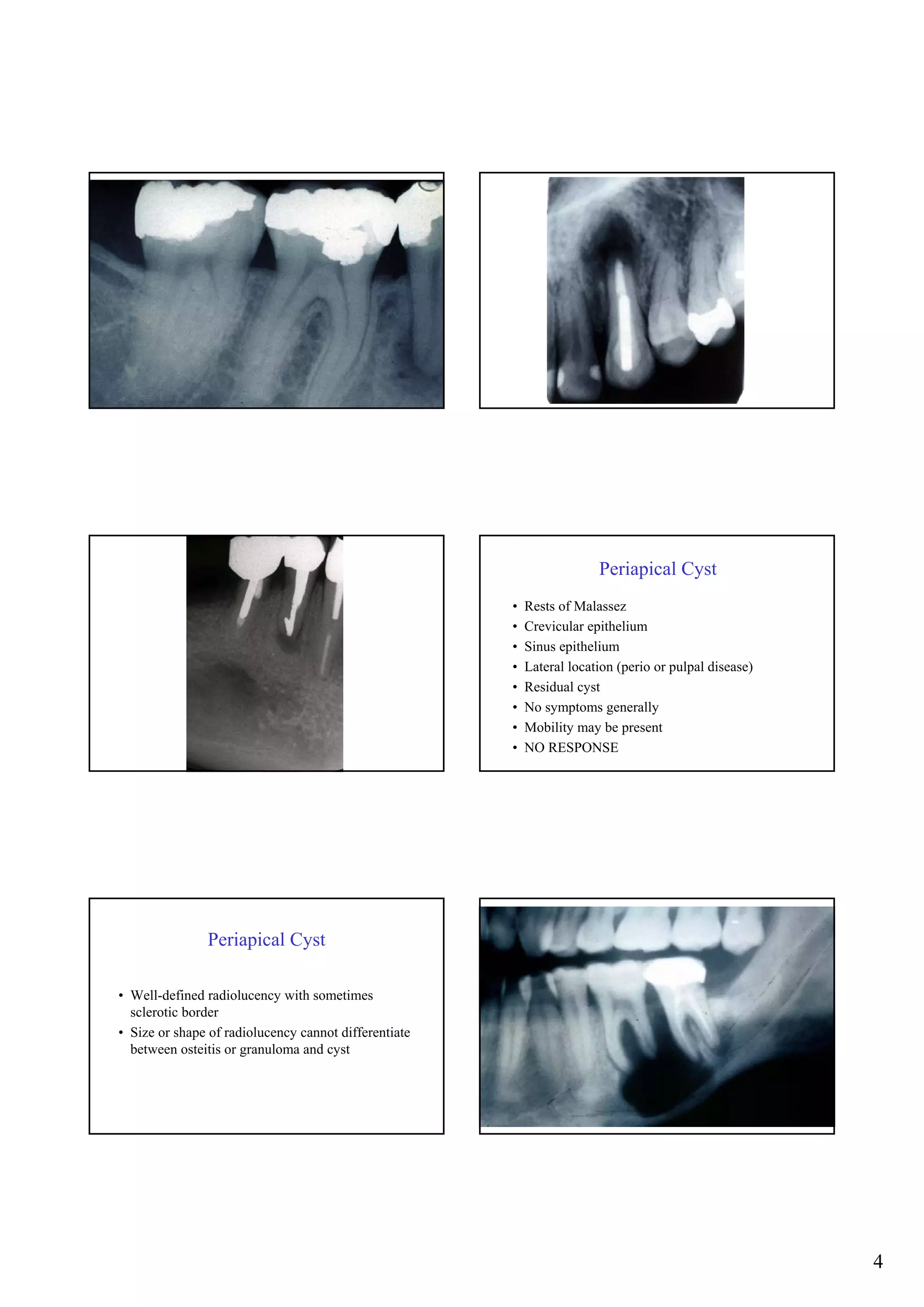 05 pulp, periapical, osteomyelitis | PDF