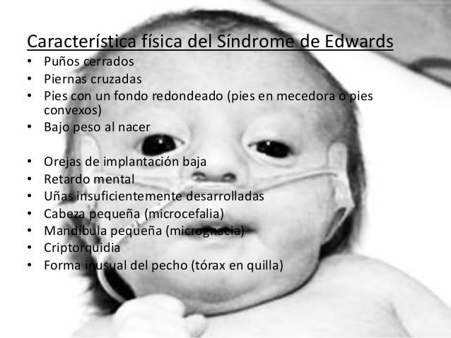 Síndrome de Edwards - Investigación escolar