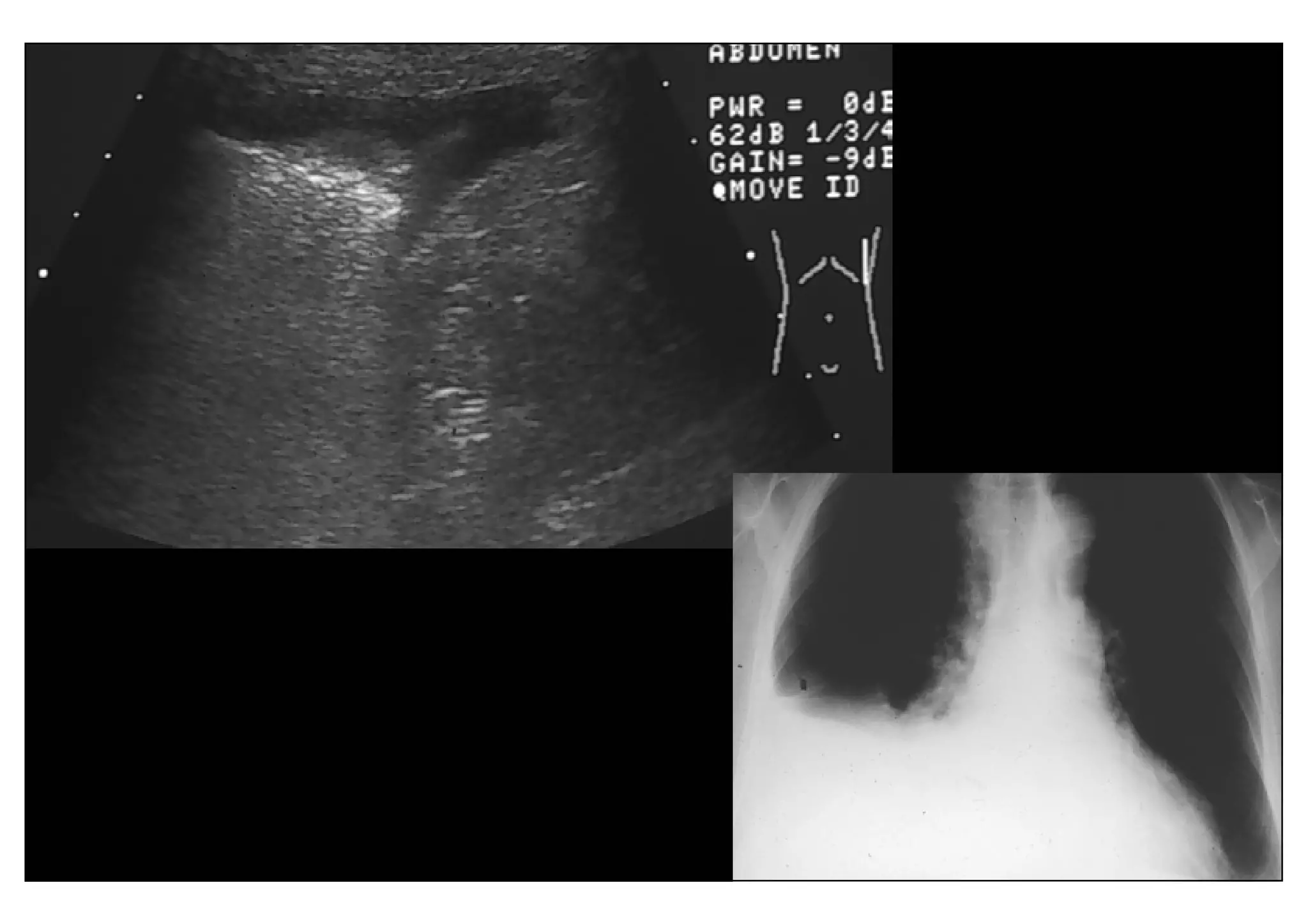 05 Sonographie des Thorax | PDF