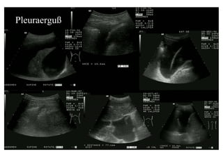 05 Sonographie des Thorax | PPT