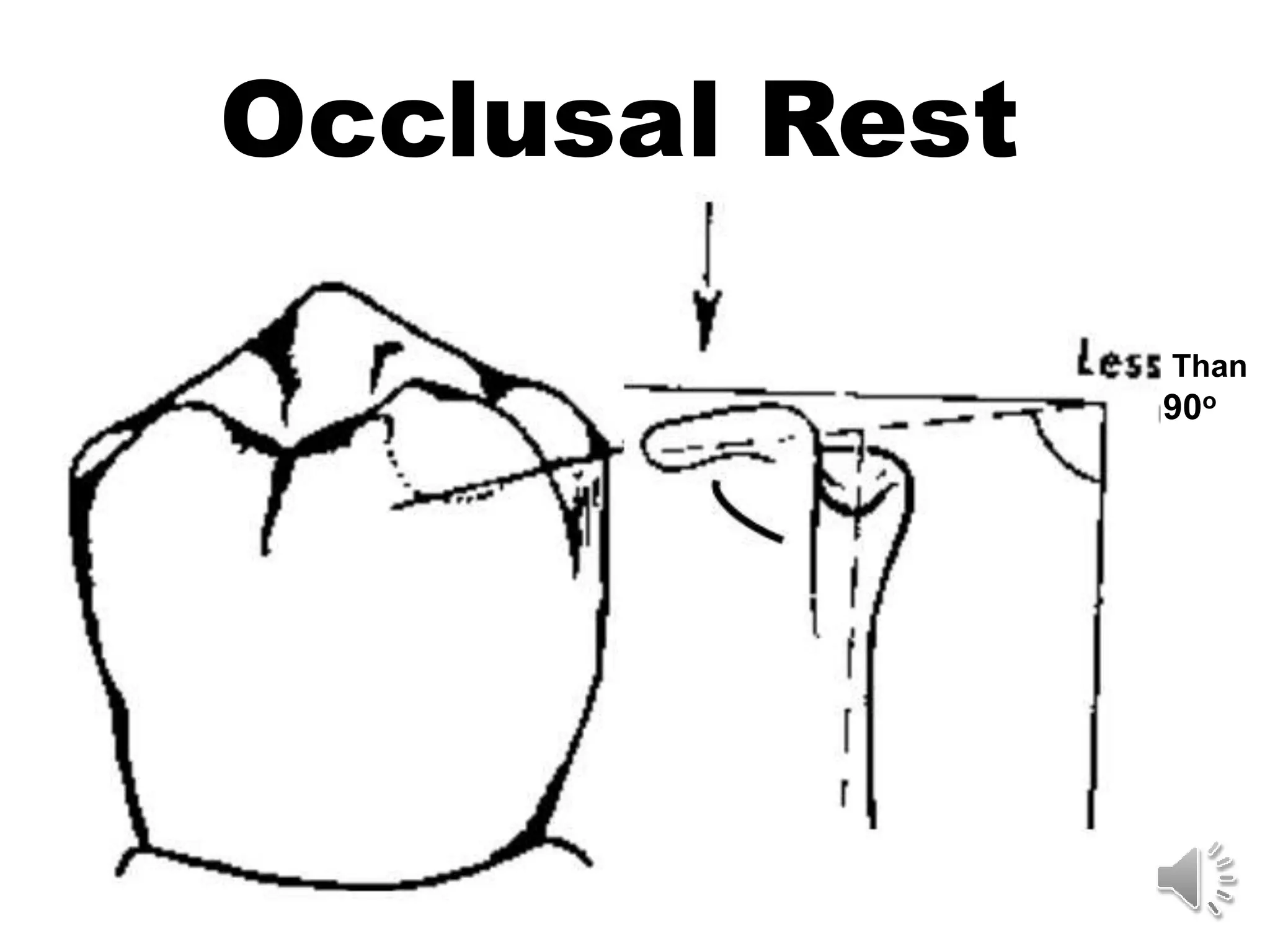 Types of tooth rests 1 | PPT | Dental Health | Diseases and Conditions