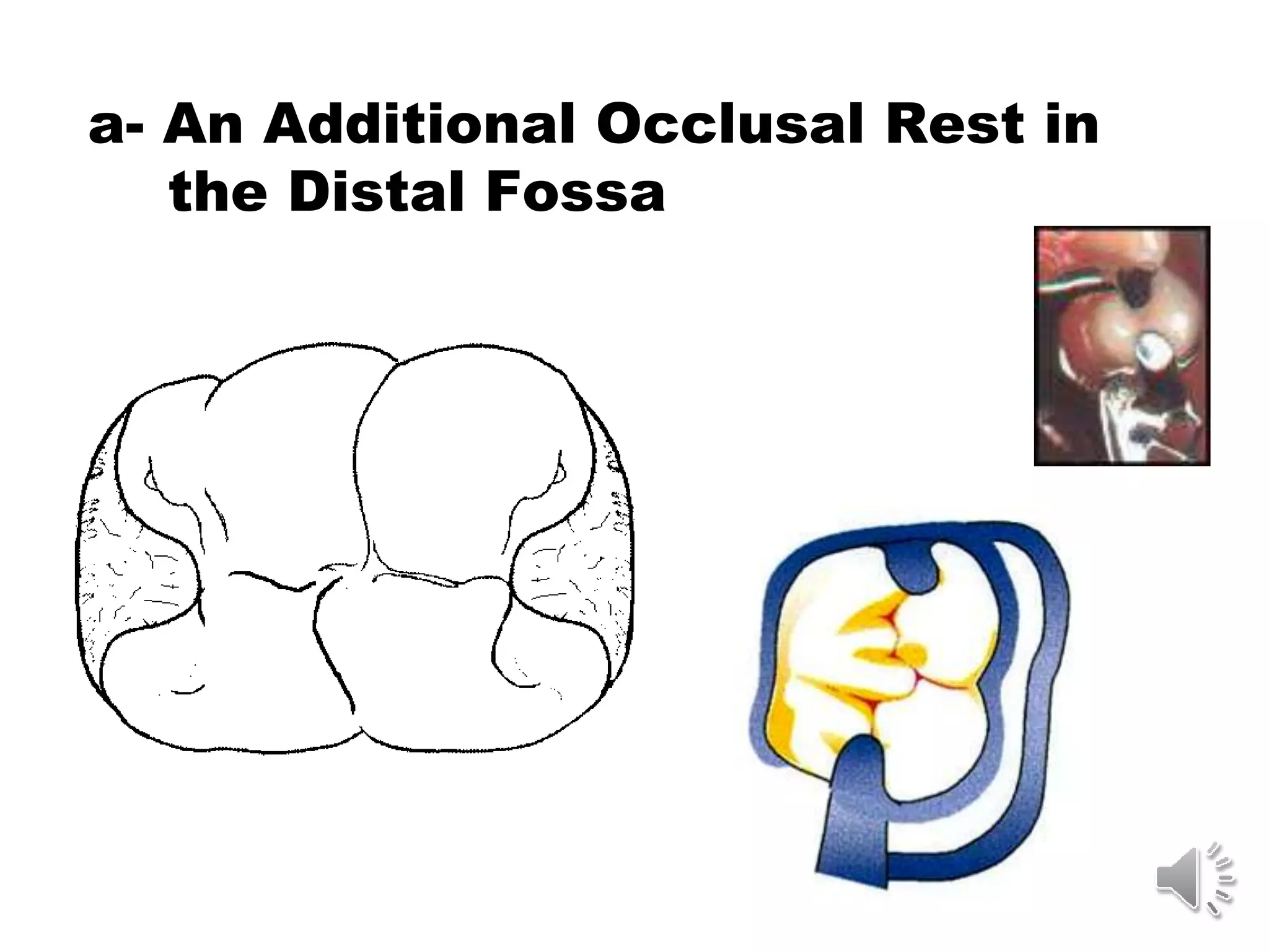 Types of tooth rests 1 | PPT | Dental Health | Diseases and Conditions