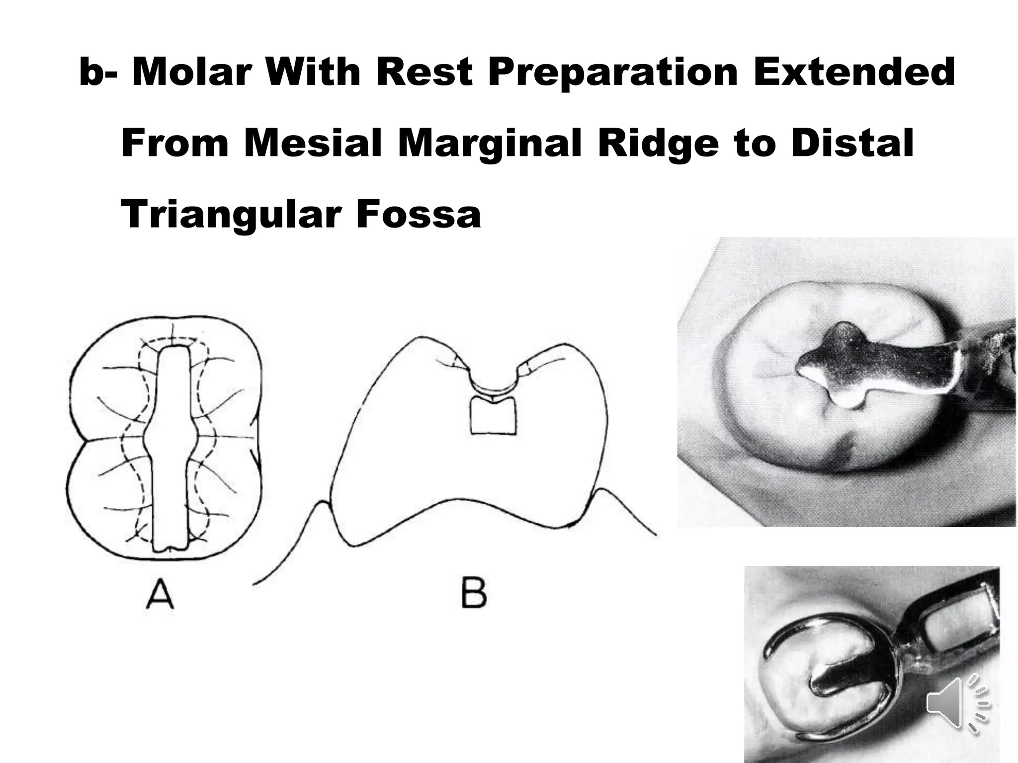 Types of tooth rests 1 | PPT | Dental Health | Diseases and Conditions