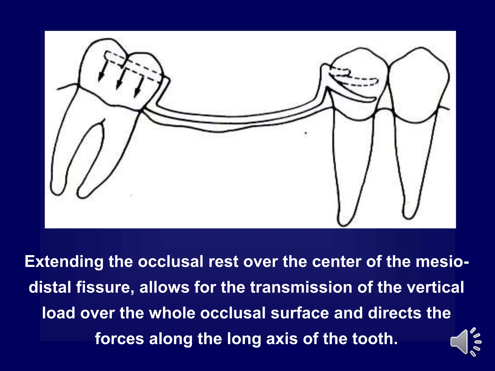 Types of tooth rests 1 | PPT | Dental Health | Diseases and Conditions