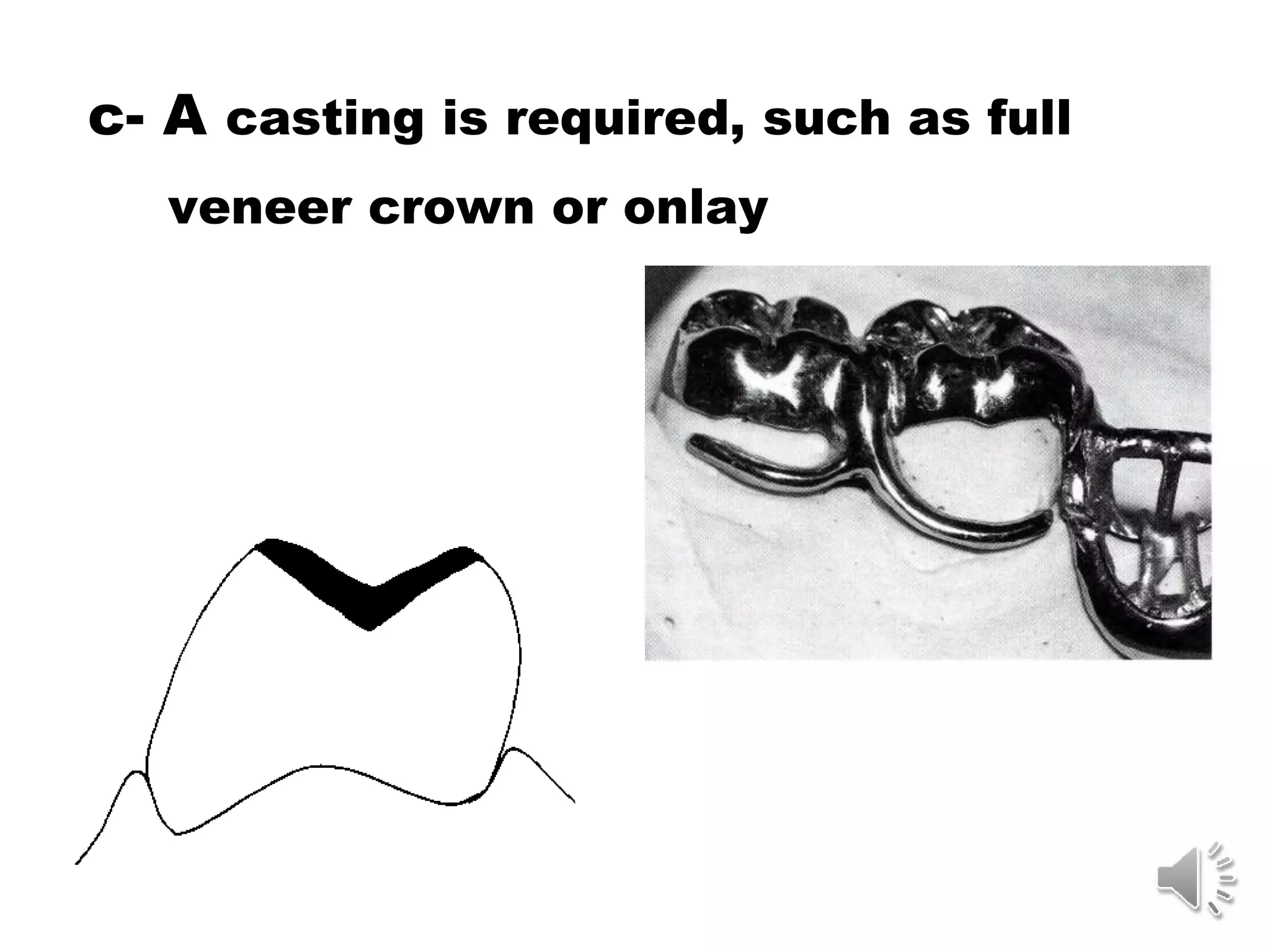 Types of tooth rests 1 | PPT | Dental Health | Diseases and Conditions