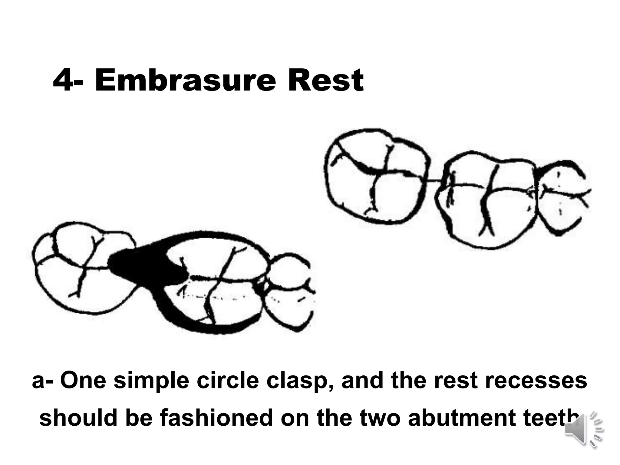 Types of tooth rests 1 | PPT | Dental Health | Diseases and Conditions