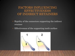 06. indirect retainers and biomechanics | PPT