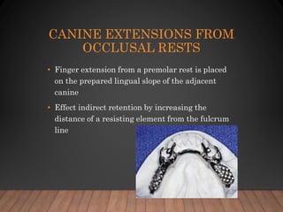 06. indirect retainers and biomechanics | PPTX | Dental Health ...