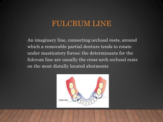 06. indirect retainers and biomechanics | PPTX | Dental Health ...