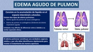 EDEMA AGUDO DE PULMON | PDF