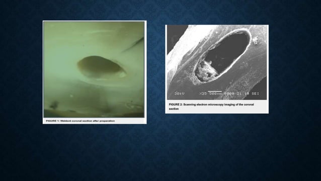 06-.pptx oval shaped root canals in endodontics | PPT