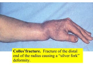 06 Appendicular Skeleton Pectoral Girdle And Upper Limbs | PPT