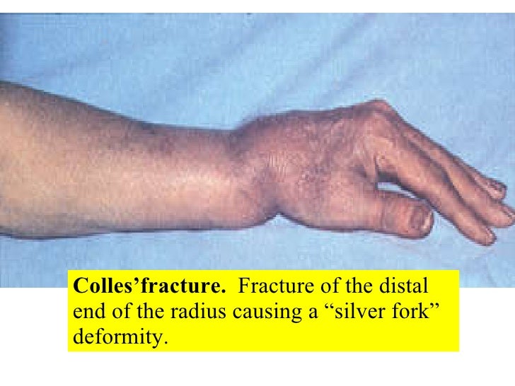 06 Appendicular Skeleton Pectoral Girdle And Upper Limbs
