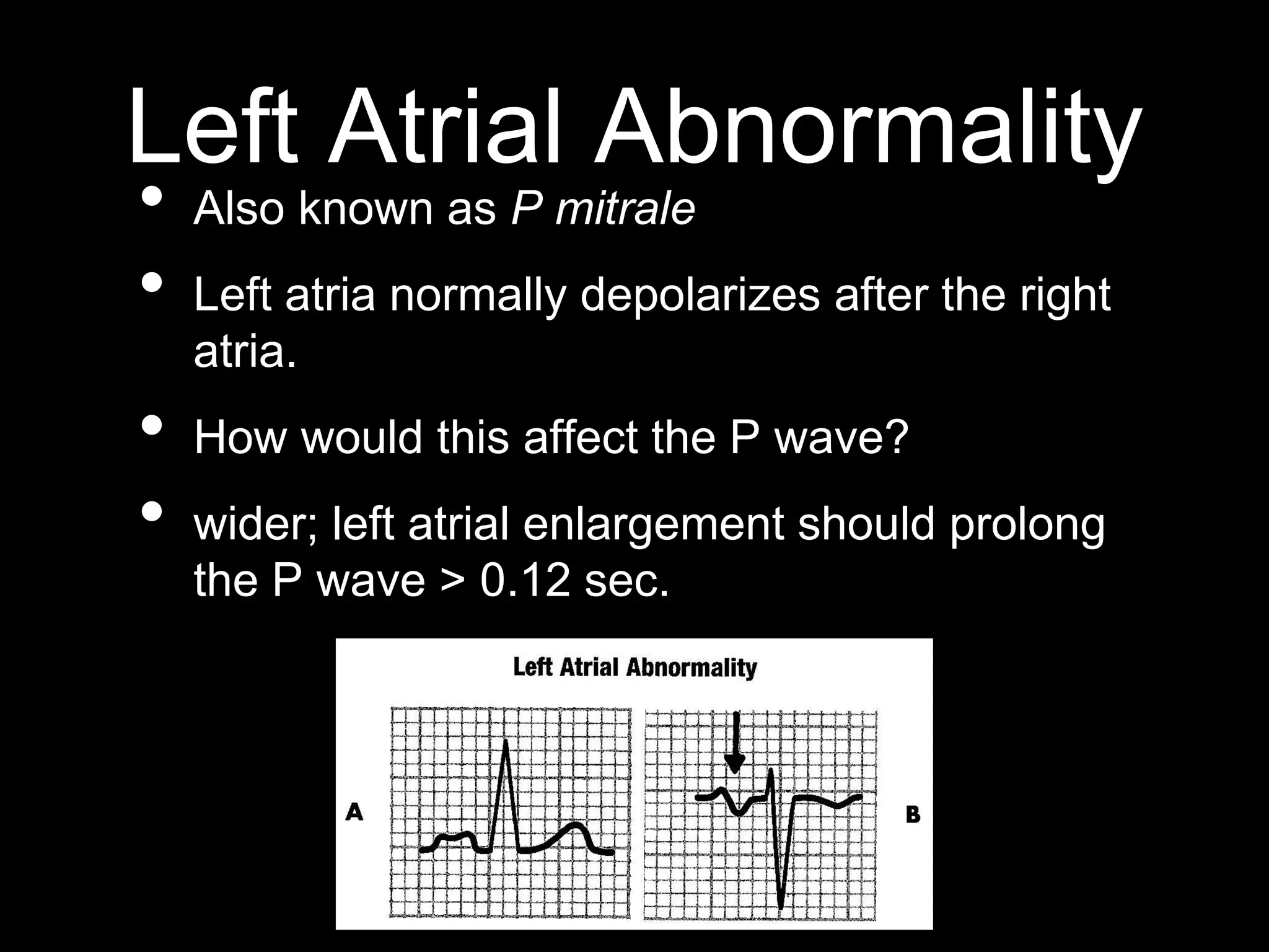 cardiac hypertrophy | PPT