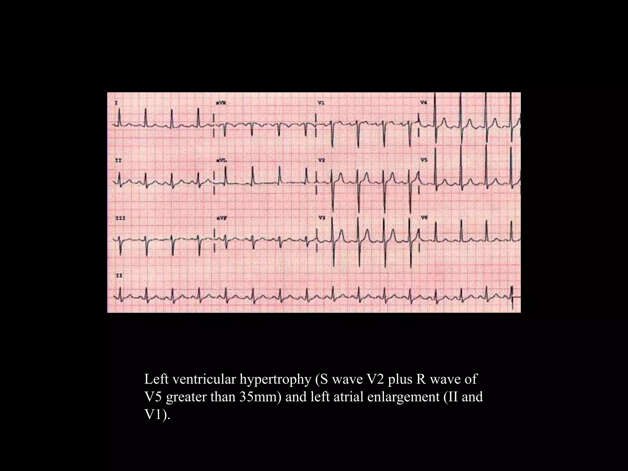 cardiac hypertrophy | PPT