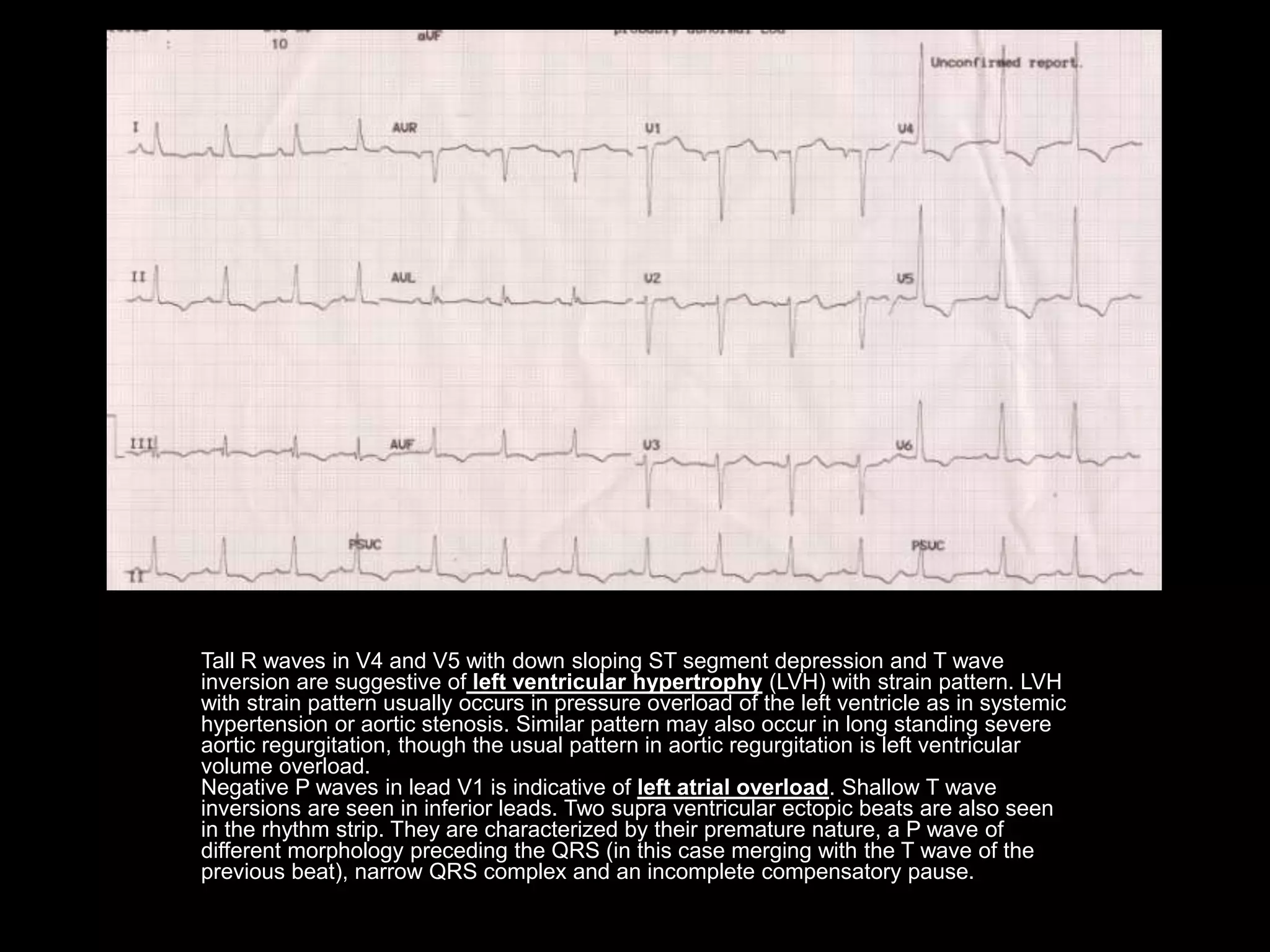 cardiac hypertrophy | PPT