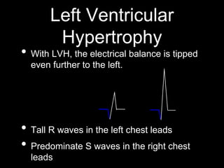 cardiac hypertrophy | PPT
