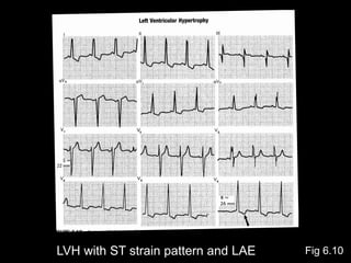 cardiac hypertrophy | PPT