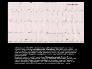 cardiac hypertrophy | PPT