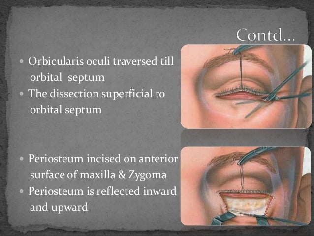 surgical approaches to the orbit