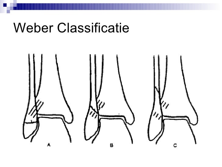 Fractuur classificatie