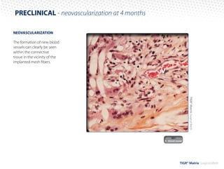 TIGR Matrix Synthetic Long Term Resorbable Surgical mesh | PPT