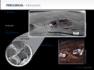 TIGR Matrix Synthetic Long Term Resorbable Surgical mesh | PPT