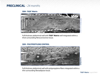 TIGR Matrix Synthetic Long Term Resorbable Surgical mesh | PPT