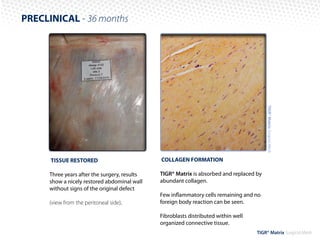 TIGR Matrix Synthetic Long Term Resorbable Surgical mesh | PPT