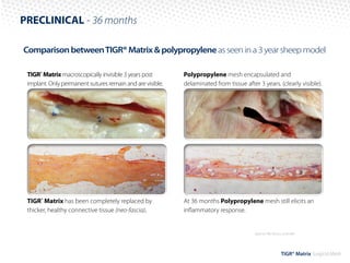 TIGR Matrix Synthetic Long Term Resorbable Surgical mesh | PPT