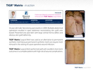 TIGR Matrix Synthetic Long Term Resorbable Surgical mesh | PPT