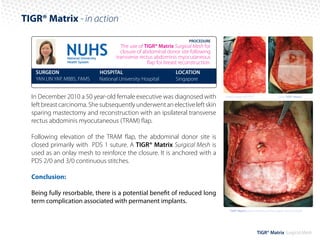 TIGR Matrix Synthetic Long Term Resorbable Surgical mesh | PPT