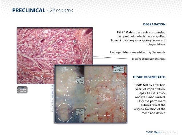 TIGR Matrix Synthetic Long Term Resorbable Surgical mesh