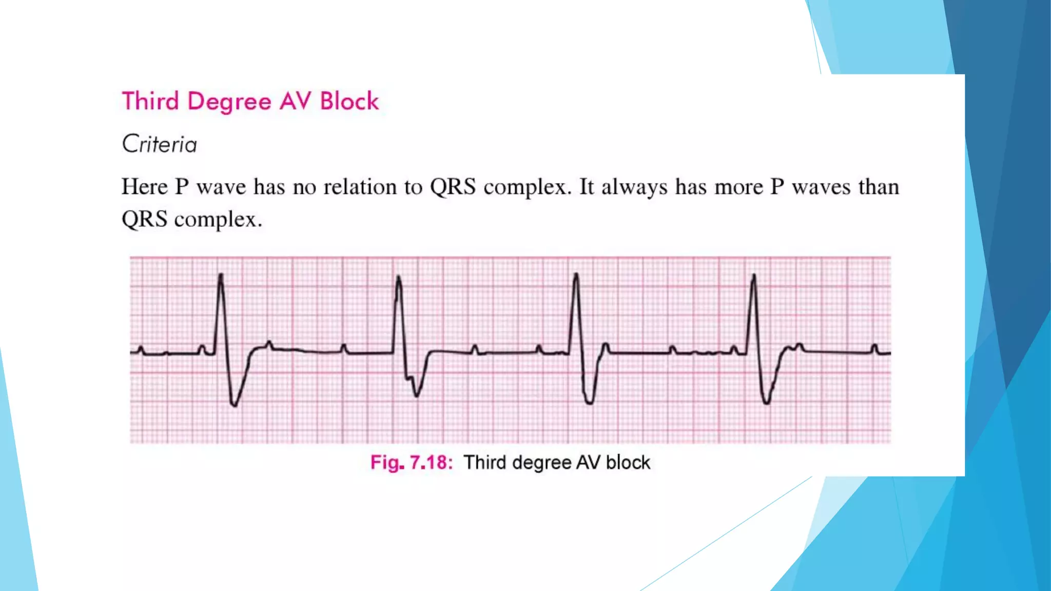ECG slides shaza PDF | PPT