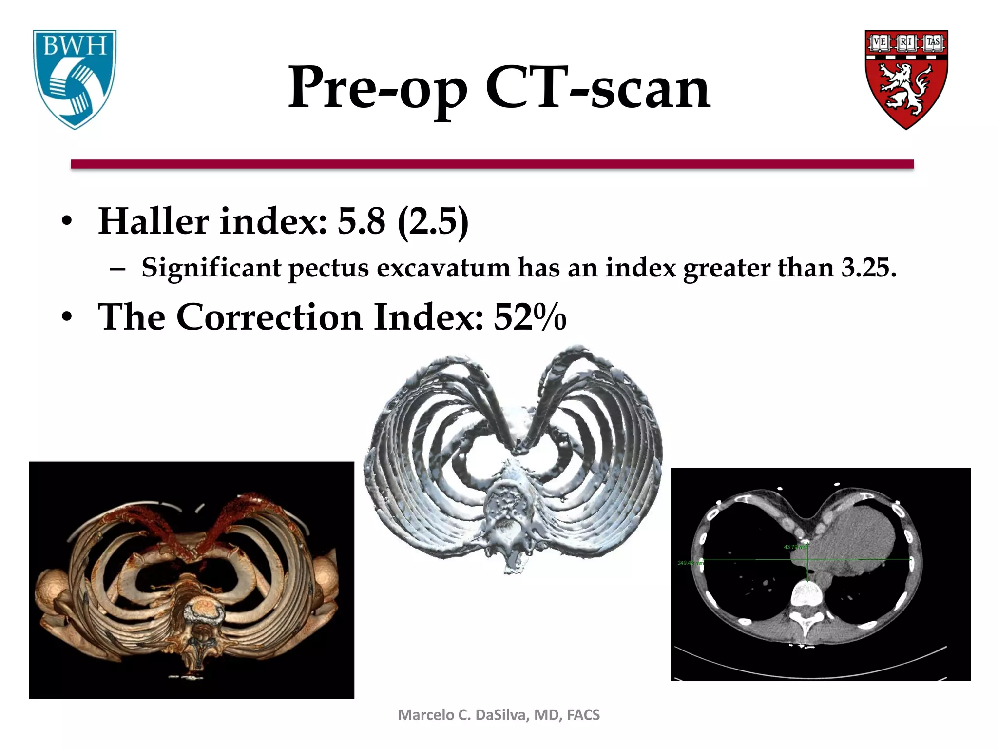 Pectus Excavatum | PDF