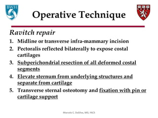 Pectus Excavatum | PDF