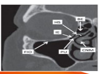 ANATOMY OF NOSE | PDF