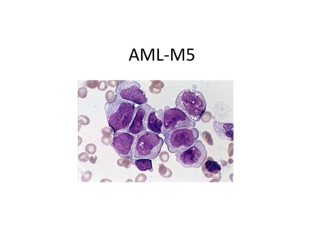 AML vs ALL 5th Semester | PPT