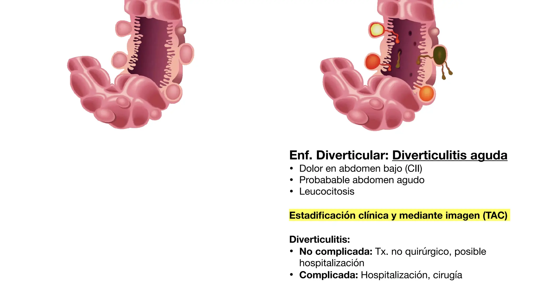 06 COMPLEMENTO - Diverticulosis y enfermedad diverticular del colon.pdf