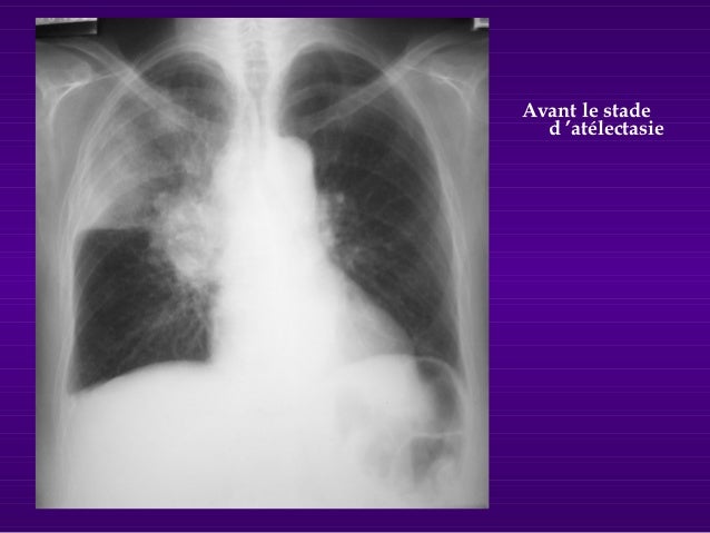 06 cours _eia_pn_semio_thx_partie.2.ppt