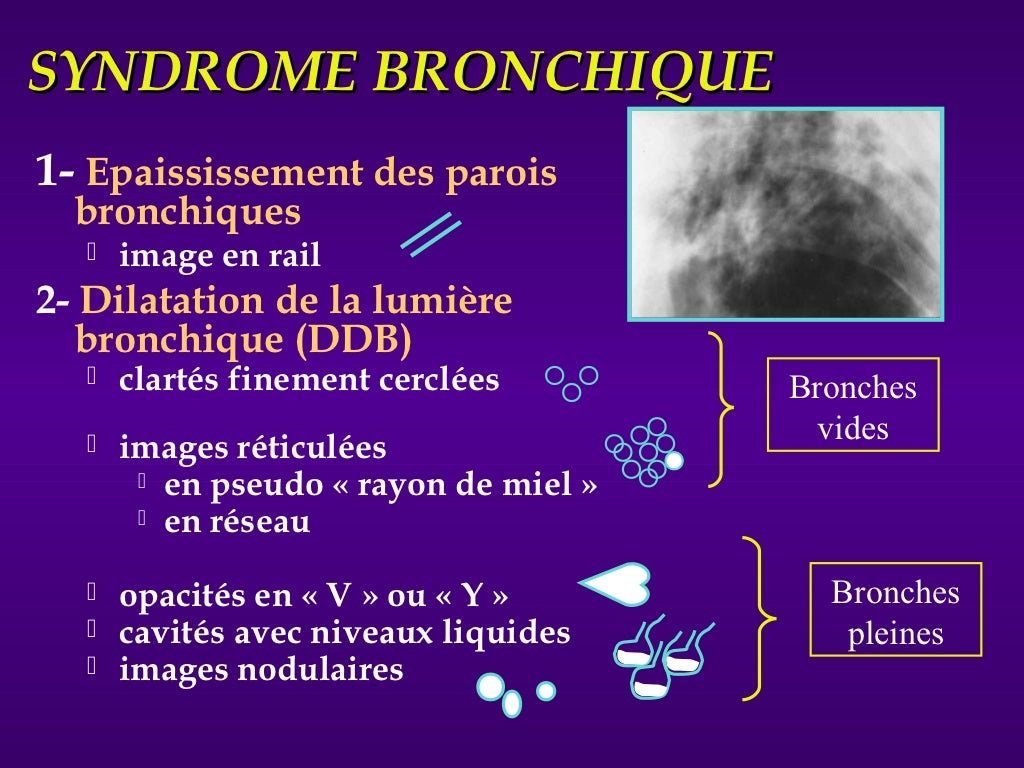 syndrome bronchique