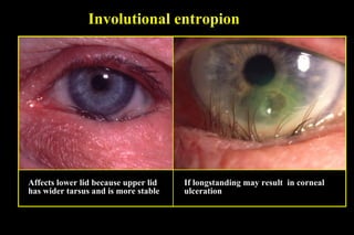 ectropion & entropion | PPT