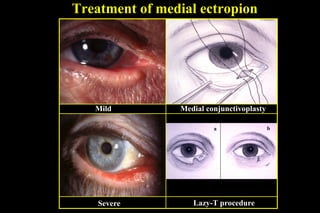 ectropion & entropion | PPT