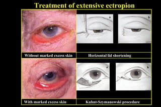 ectropion & entropion | PPT