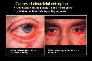 ectropion & entropion | PPT