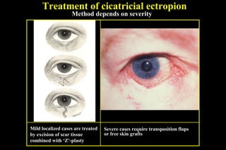 ectropion & entropion | PPT