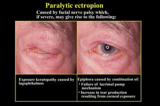 ectropion & entropion | PPT